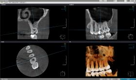 CBCT slikanje