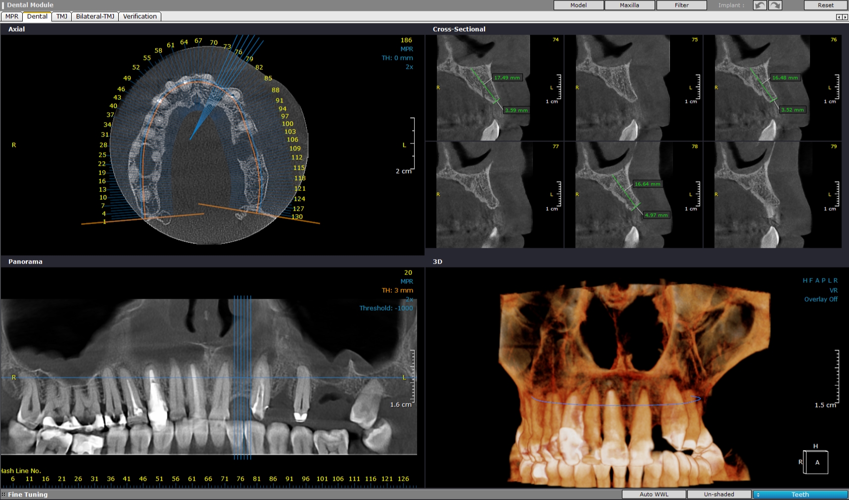 CBCT slikanje